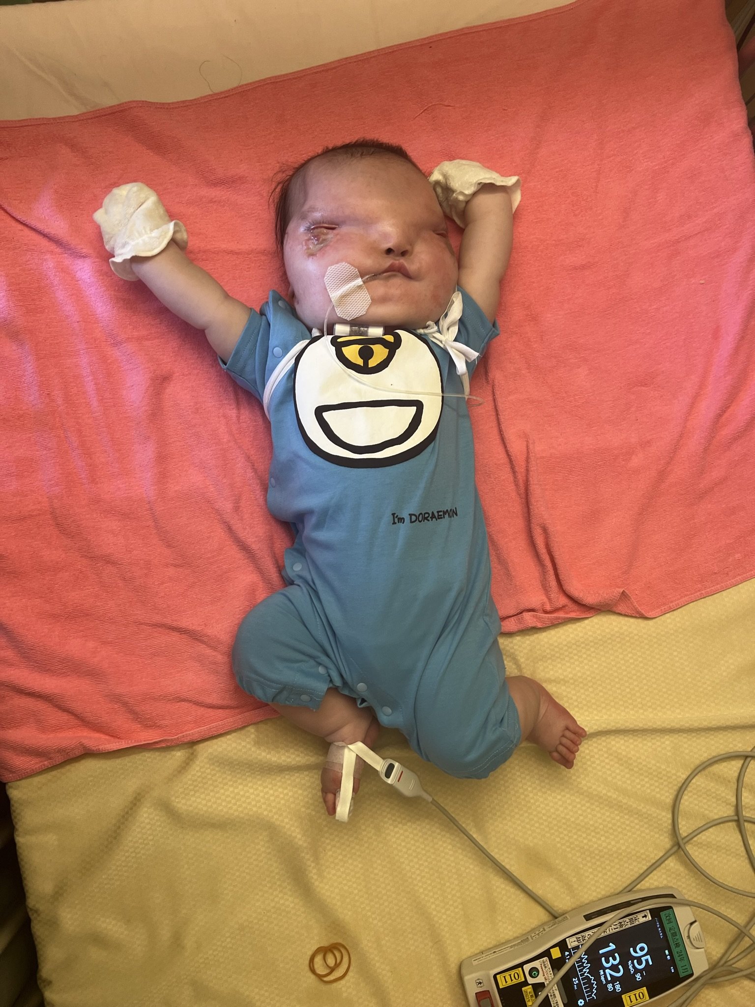 「寝るときは目に軟膏とラップ」病名すら不明の難病児「寝たきりの可能性も想定された中で…成長は奇跡」｜CHANTO WEB