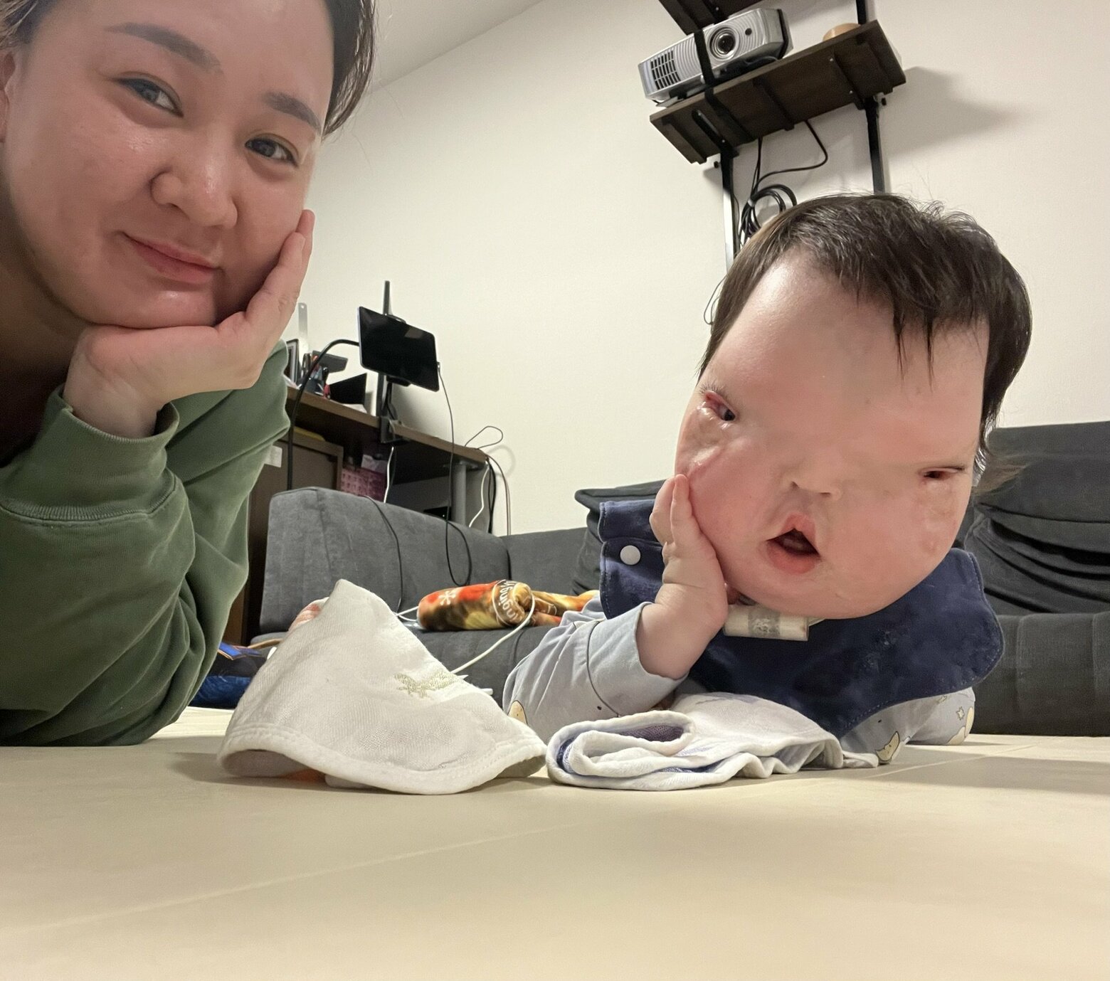 まぶたと頭蓋骨欠損…「お顔に特徴があるなら、見慣れてもらうしかない」とYouTube配信を始めた両親の「覚悟」｜CHANTO WEB